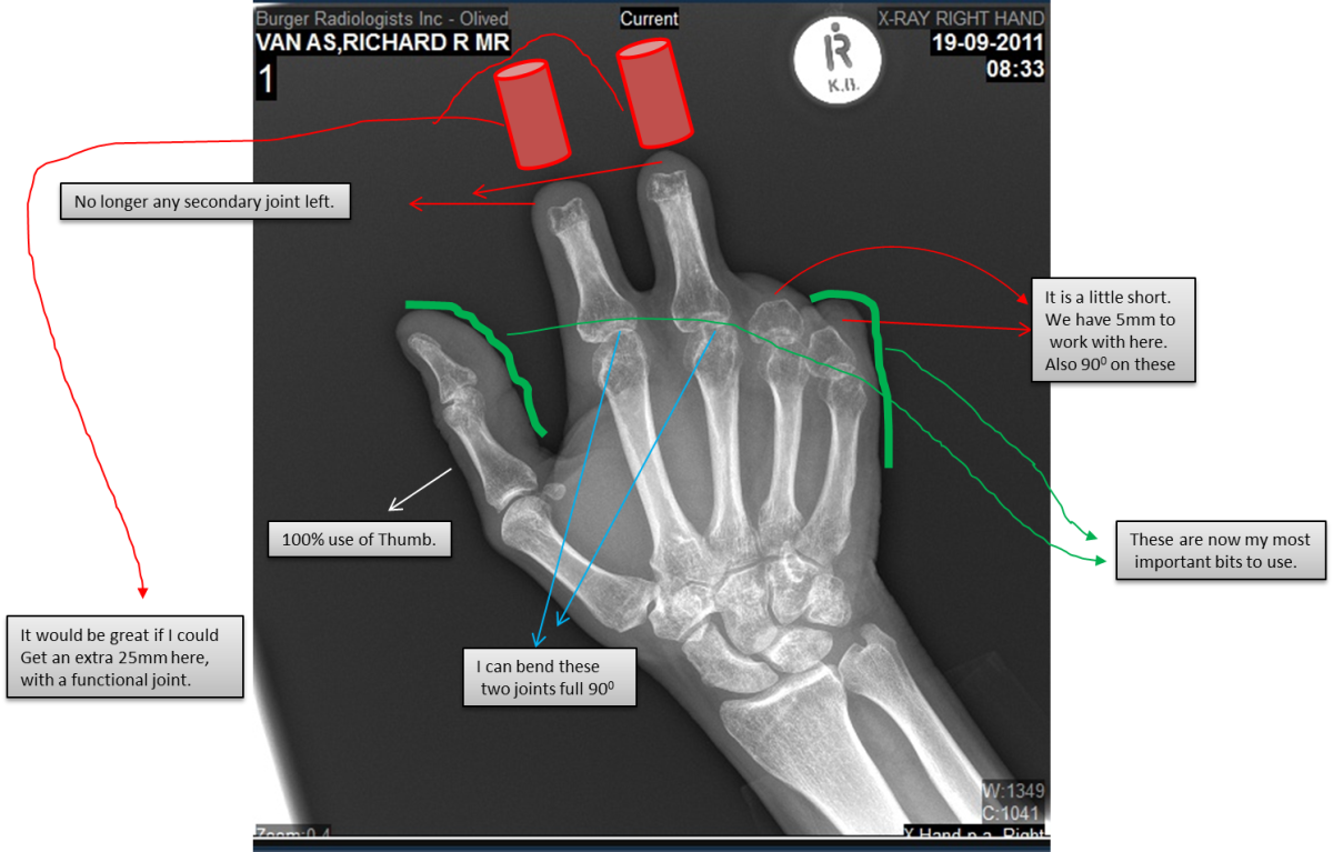 Amazing 3D Printed ‘Robohand,’ Gives Dozens of Amputees the Power to ...