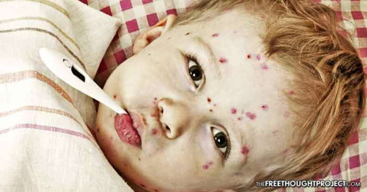 School Bans Unvaccinated Kids After Immunized Children Start Chickenpox ...